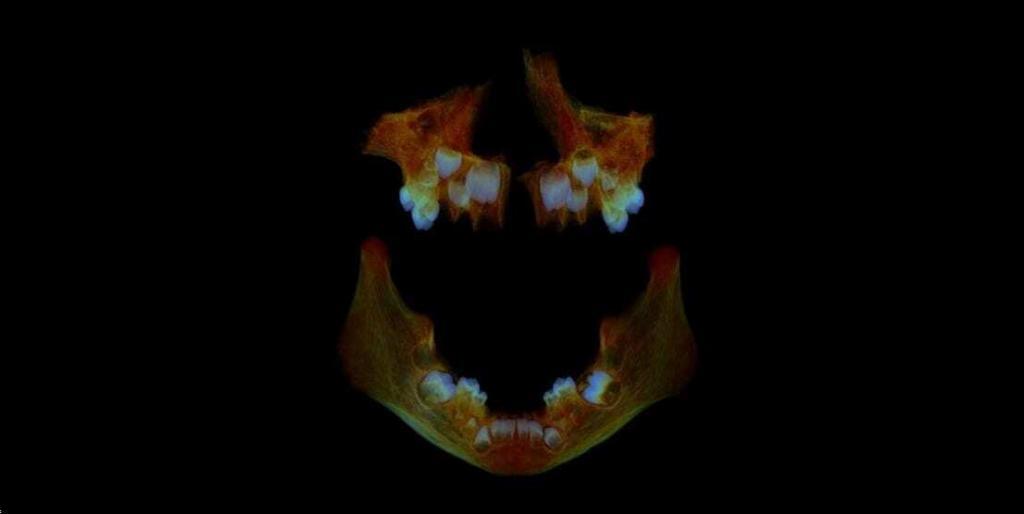 What Anglo Saxon teeth can tell us about modern health