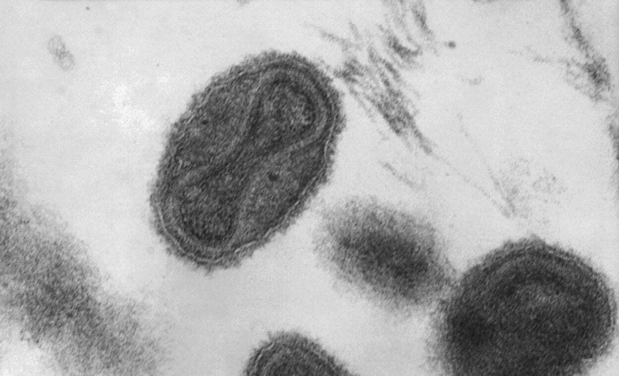 Researchers Find Evidence of Smallpox in the Viking Age